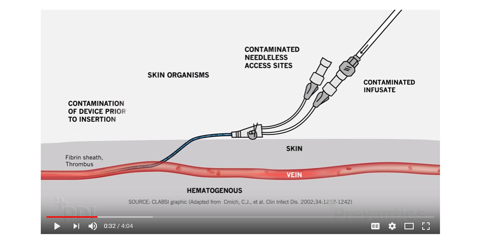 Potential Sources of CLABSIs - PDI Healthcare